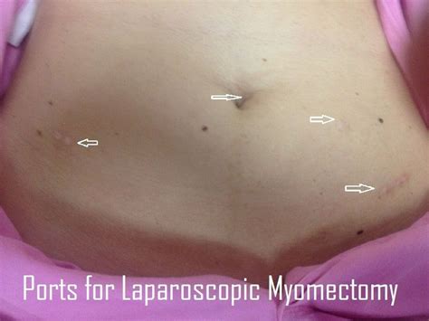 Port Position Of Various Laparoscopic Gynecological Surgeries
