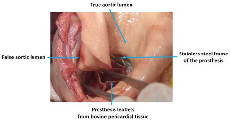 Autopsy Finding Of Thoracic Aorta Dissection With An Entry Closely
