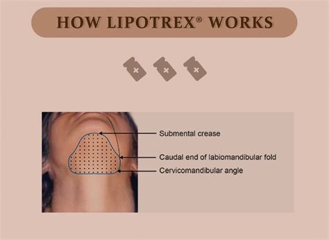 Lipotrex Smooth Lipolytic Solution Buy Lipotrex Smooth Lipolytic Solution Lipotrex Smooth