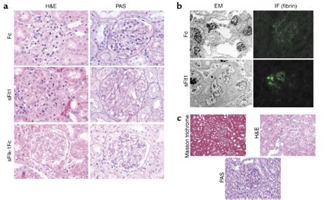 Sflt1 Induces Glomerular Endotheliosis A Histopathological Analysis