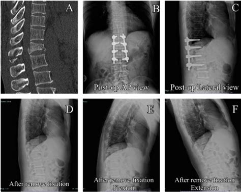 Example Case I Male Years Old With Fracture L That Treat With
