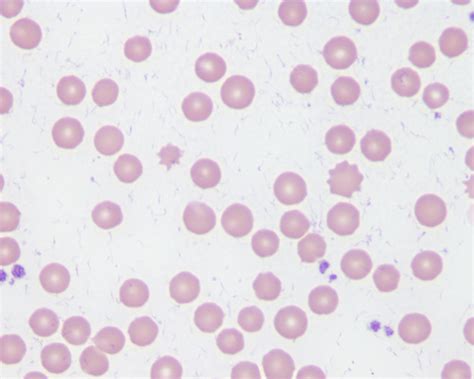 Eperythrozoon Archives Eclinpath