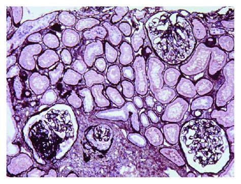 Practical Application Of Columbia Classification For Focal Segmental