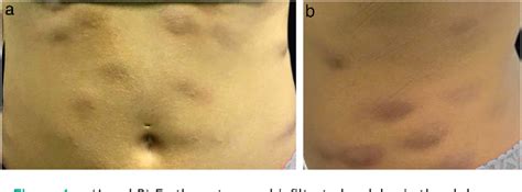 Figure 1 From Cutaneous Infection By Mycobacterium Lentiflavum After Subcutaneous Injection Of