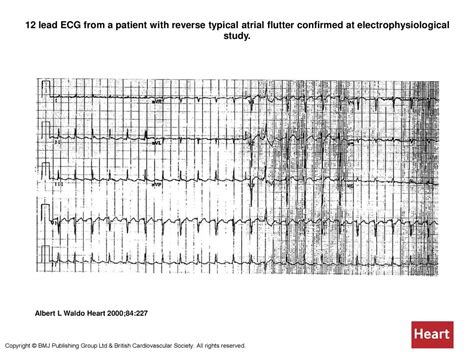 12 Lead Ecg From A Patient With Reverse Typical Atrial Flutter Confirmed At Electrophysiological