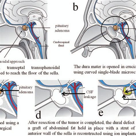 Color Online Surgery Of Enucleation Of Pituitary Adenoma By