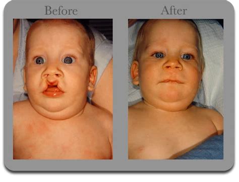 Cleft Palate Surgery
