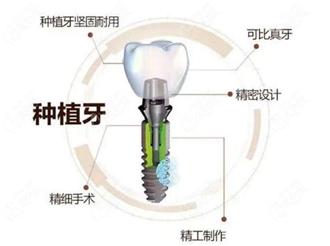 嵊州种植牙多少钱一颗含嵊州各口腔医院种植牙价格 美佳社区