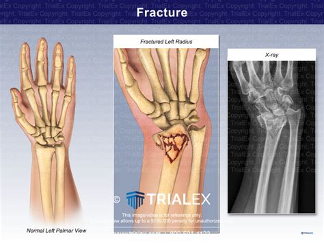 Fracture Trialquest Inc
