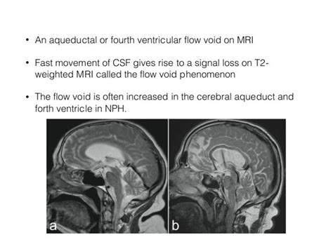 Surgical Management Of Nph