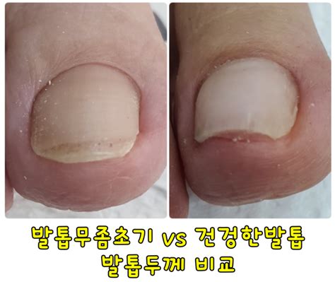 구리네일샵손끝향기 발톱무좀초기증상 발톱무좀초기관리 네이버 블로그