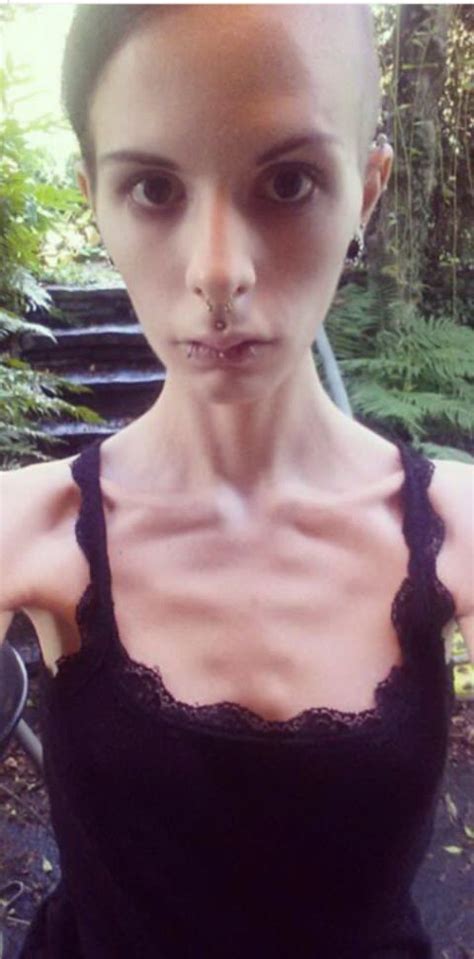 厌食症美女把食物藏在耳朵，连食物都不敢碰怕被皮肤吸收 厌食症 食物 耳朵 新浪新闻