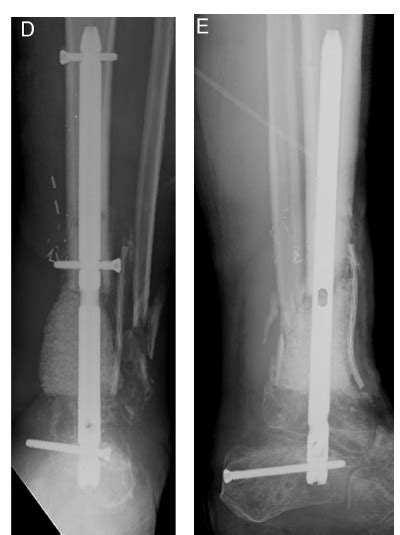 Masquelet 技术:骨缺损修复新选择! 德医医学 助力医学教育发展! Masquelet 技术:骨缺损修复新选择! 德医医学 助力医学教育发展!