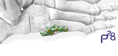Paragon 28 Launches 5th Metatarsal Fracture Plating System