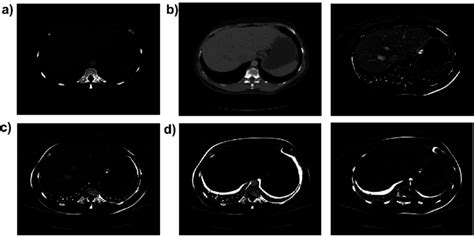2 L Norm Based Nmu Segmentation Of The Nbe Three Phase Ct Image Shown