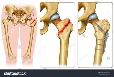 Illustration Fracture Femur Bone Fracture Femoral Stock Illustration