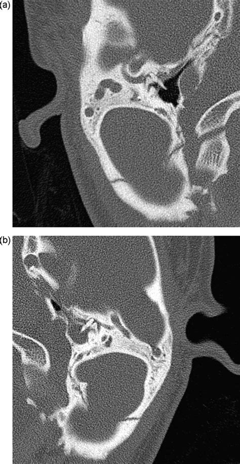 A Axial Ctof Right Temporal Bone Demonstrating An Abnormal Download Scientific Diagram