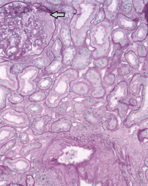Cross Section Of Temporal Artery Biopsy That Shows Heavy Adventitial Download Scientific