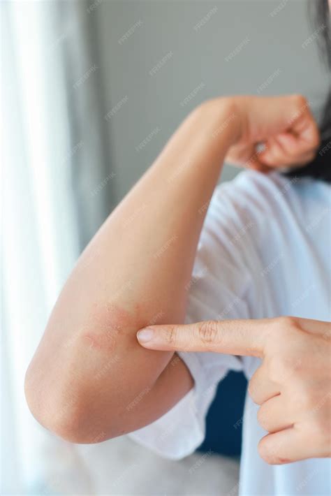 Premium Photo Closeup Of Skin Asian Woman With Acute Psoriasis On Her Elbows Autoimmune