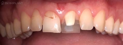 Home Bioimplant Ceramic Root Analogue Rai Dental Implant Solutions