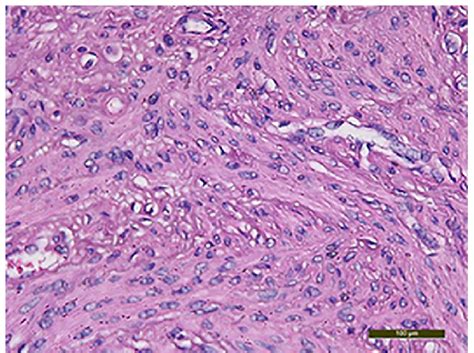 Anastomosing Fascicular Pattern Of Spindle Shaped Smooth Muscle Cells