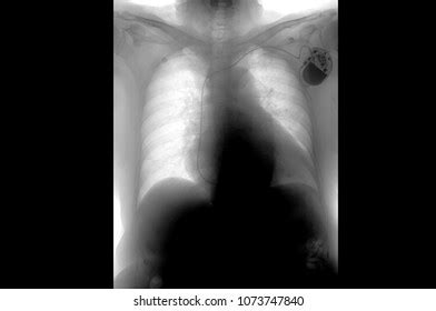Chest Xray Image Dual Chamber Cardiac Stock Photo Shutterstock