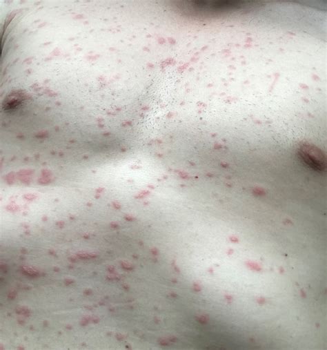Phytophotodermatitiswhen The Plants Fight Back St Emlyn S