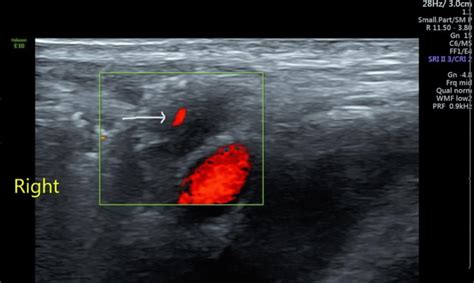 What You Should Know About Vasitis A Case Report Pmc