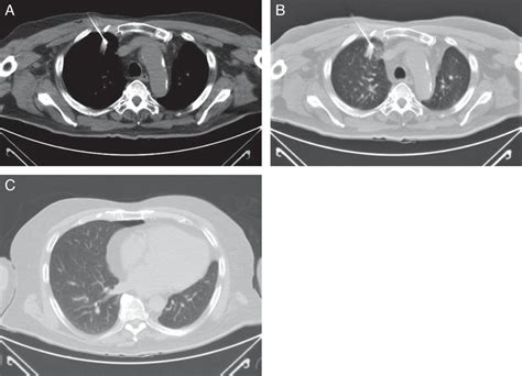 Pneumothorax After Transthoracic Needle Biopsy Of The Lung Thoracic Key