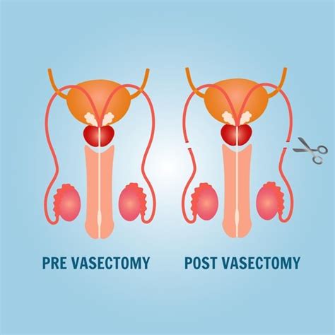 Vasectomy Procedure Reversal