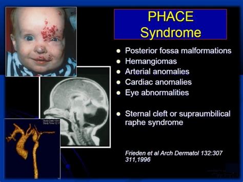 Infantile Hemangioma Ppt