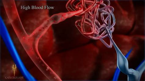 Arteriovenous Malformation Malformasi Arteri Vena
