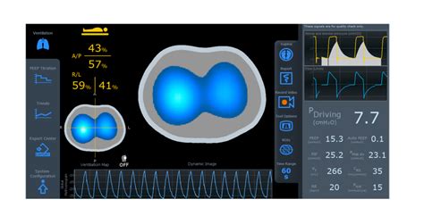 Monitoring Lung Function With Electrical Impedance Tomography In The