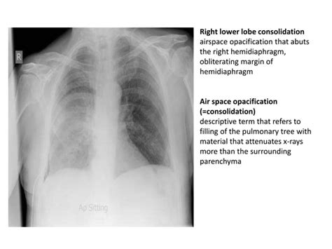 Non Tb Pulmonary Infection Pptx Lung And Respiratory Health