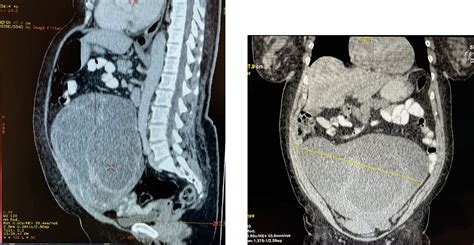 Figure 1 From Ovarian Granulosa Cell Tumor Case Report And Literature