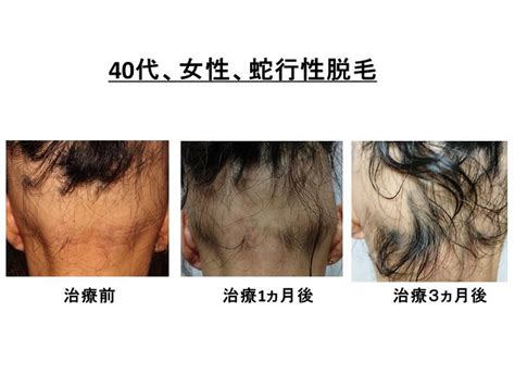 遠隔診療で治療中の、蛇行性脱毛の患者様で、改善！ 患者様からの声・メディア掲載・クリニックからのお知らせ 名古屋kクリニック