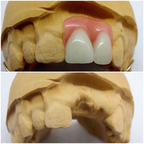 Acrylic Partial Denture Flipper Dental Lab Direct