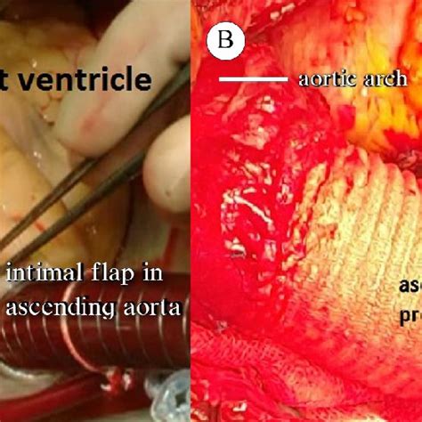 A Perioperative Image Shows The Aortic Dissection And The Intimal Flap