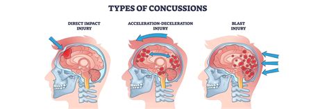 Concussions And Returning To Activities Element Chiropractic