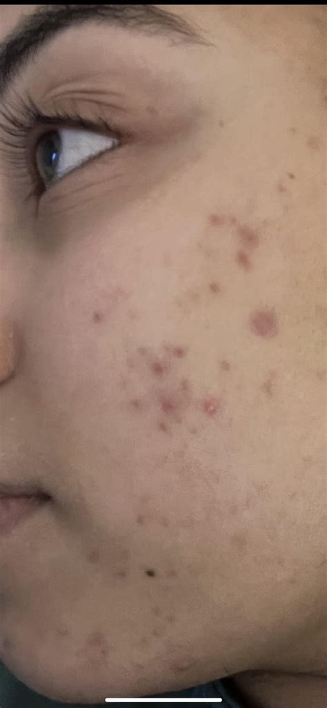 Journey Of Healing Hormonal Acne Rhormonalacne