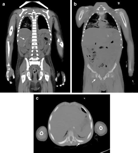 An Unenhanced Postmortem Computed Tomography Scan Of The Thorax And Download Scientific Diagram