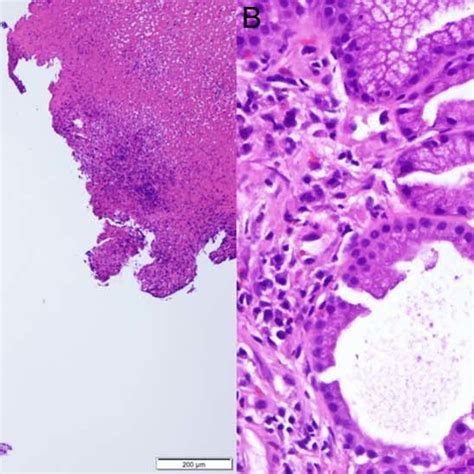 Biopsies Of The Duodenal Bulb Ulcers Showing A Active Chronic