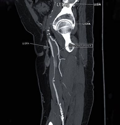 Left Femoral Artery Curve For Peripheral Arterial Disease Diagnosis