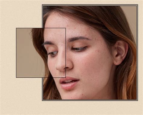 Yeast Infection On Face Or Lips Symptoms Causes Diagnosis Treatment