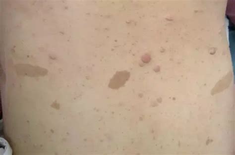 咖啡斑究竟是一种先天皮肤病还是属于后天的疾病呢属于后天的话是怎么长出来的呢如果是先天还会不会改变呢 知乎