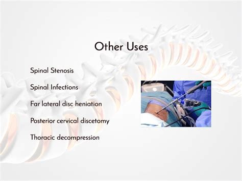 Endoscopic Spine Surgery Slipped Disc Spinal Fusion Surgery Mumbai