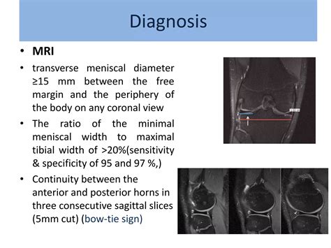 Discoid Meniscus Ppt