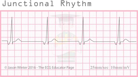 Junctional Rhythm Types