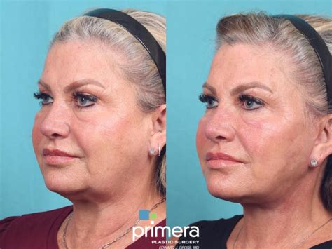 Mini Facelift Before And After Pictures Case 904 Orlando Winter Park