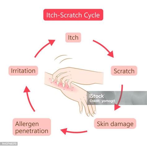 คันวงจรรอยขีดข่วนภาพประกอบมือ แห้ง โรคผิวหนังและสภาพกลากภูมิแพ้ แนวคิดการดูแลผิวสุขภาพด